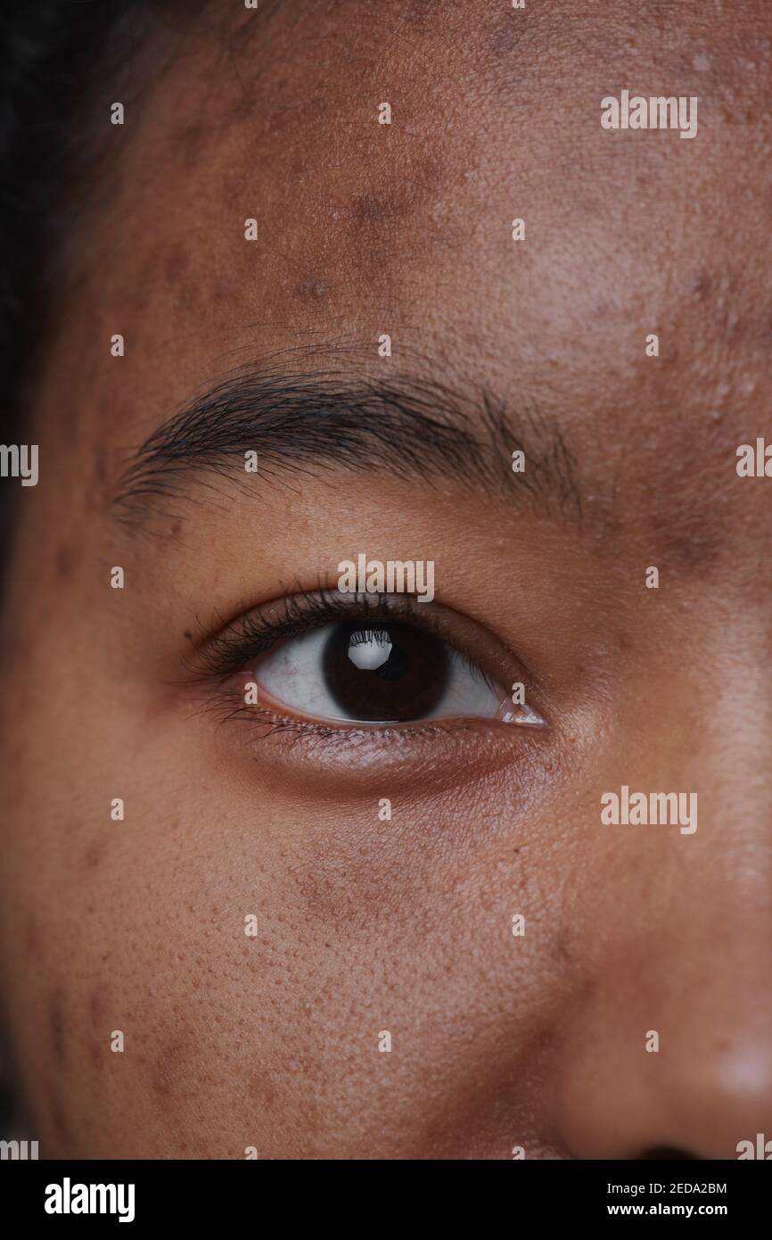 Skin imperfections hi-res stock photography and images - Alamy