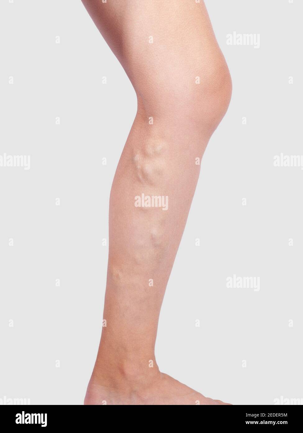 female leg with varicose veins,distended veins Stock Photo - Alamy