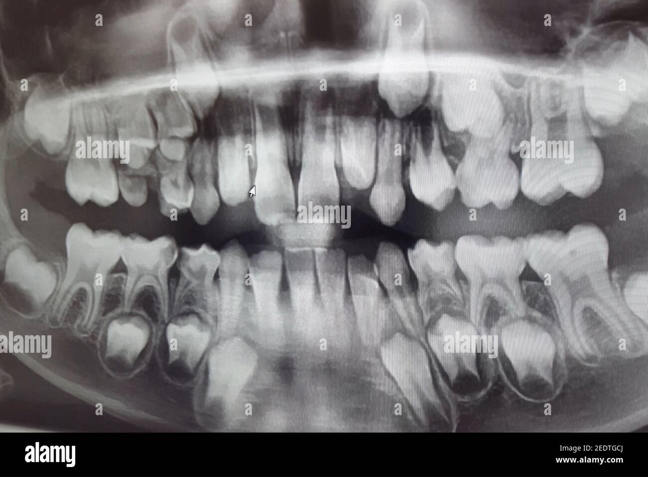 Teeth x ray baby hi-res stock photography and images - Alamy