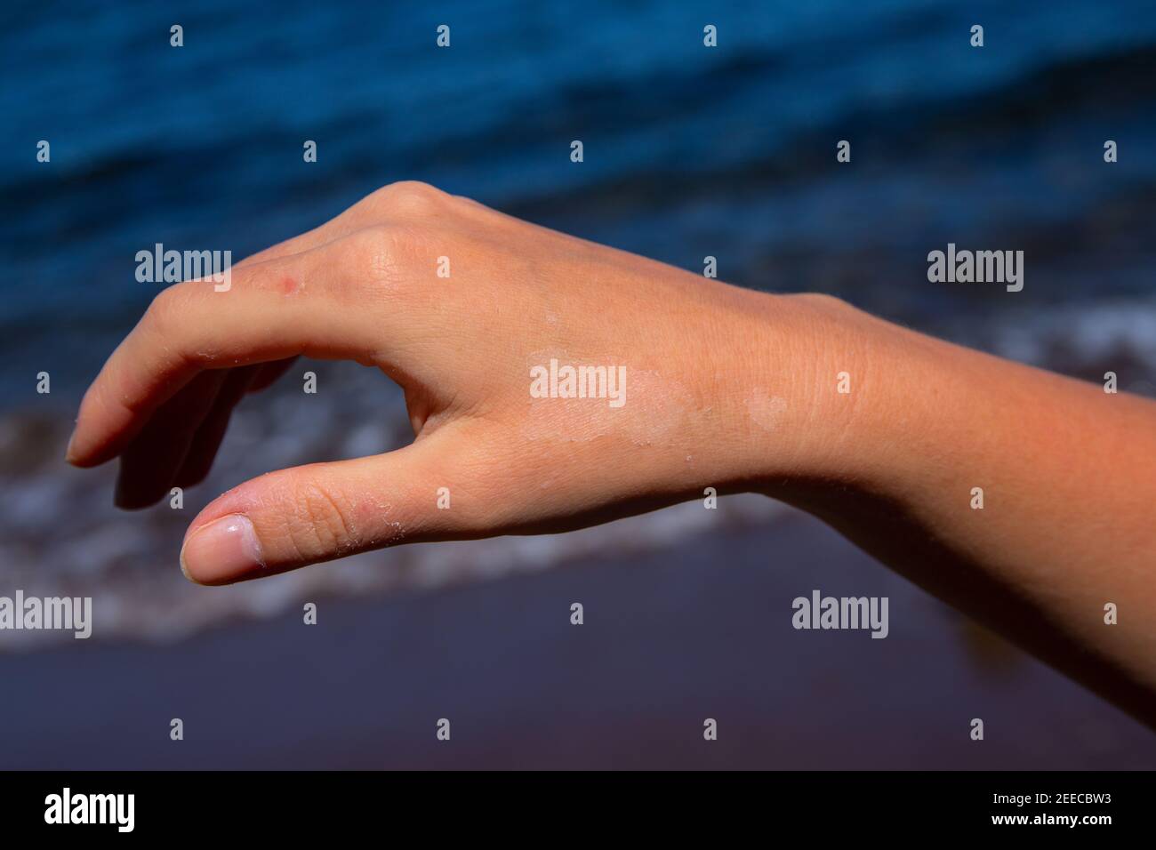 Sunburned skin with peel on tropical sea background. Sun burned female ...