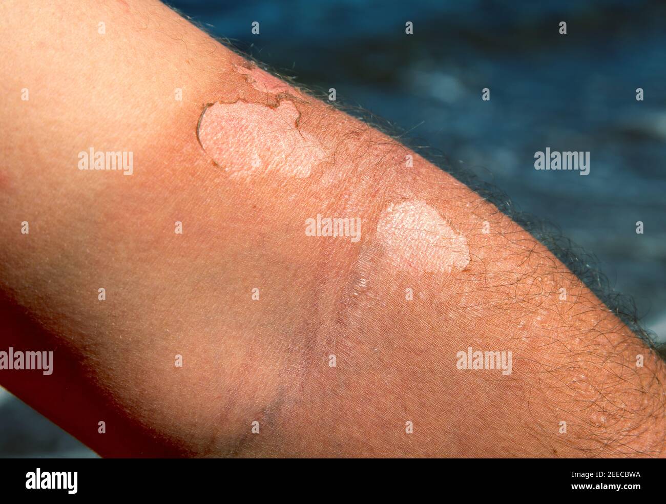 Sunburned arm hi-res stock photography and images - Alamy