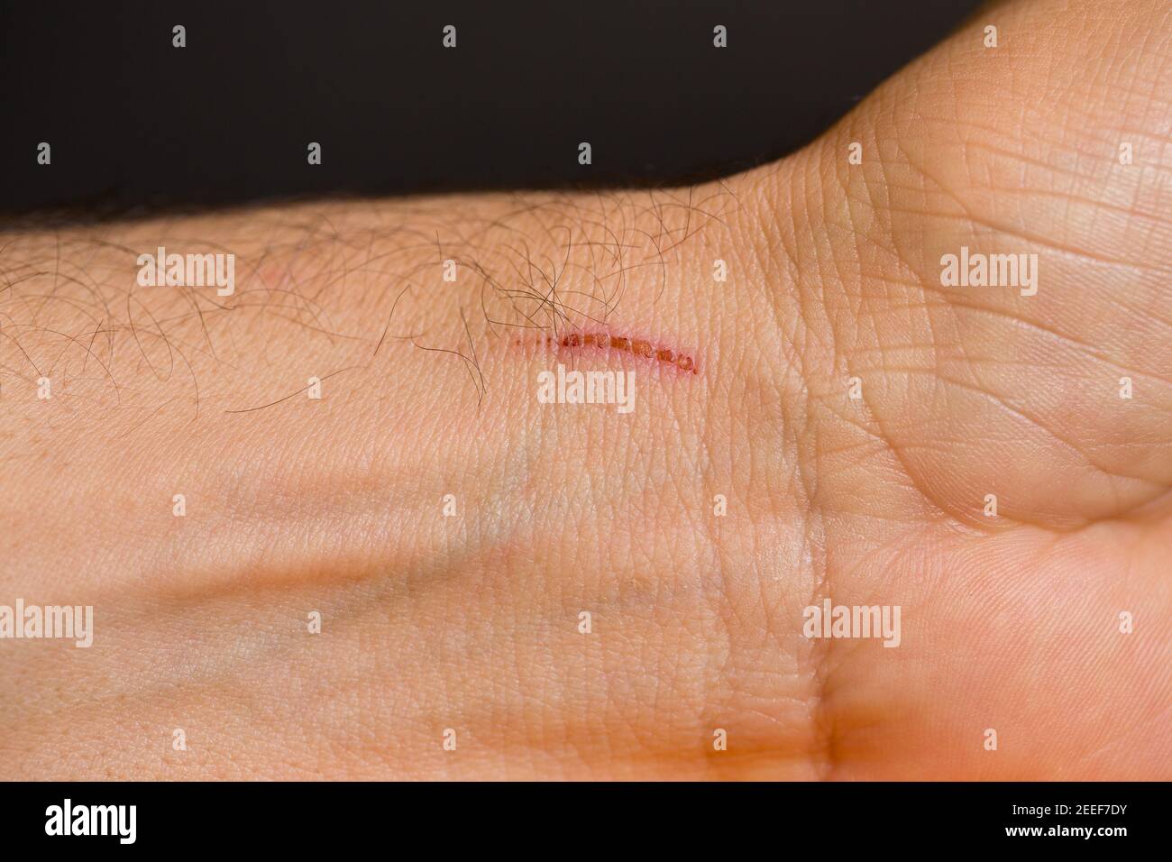 scab over wrist closeup Stock Photo - Alamy