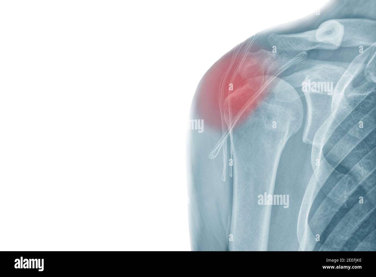 Lateral scapula x ray hi-res stock photography and images - Alamy