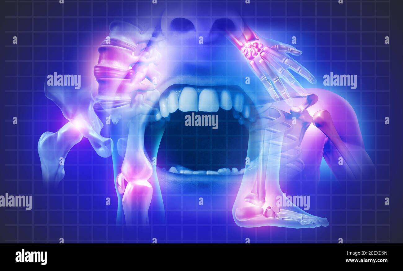 Pain of the joints concept as skeleton and muscle anatomy of the body ...