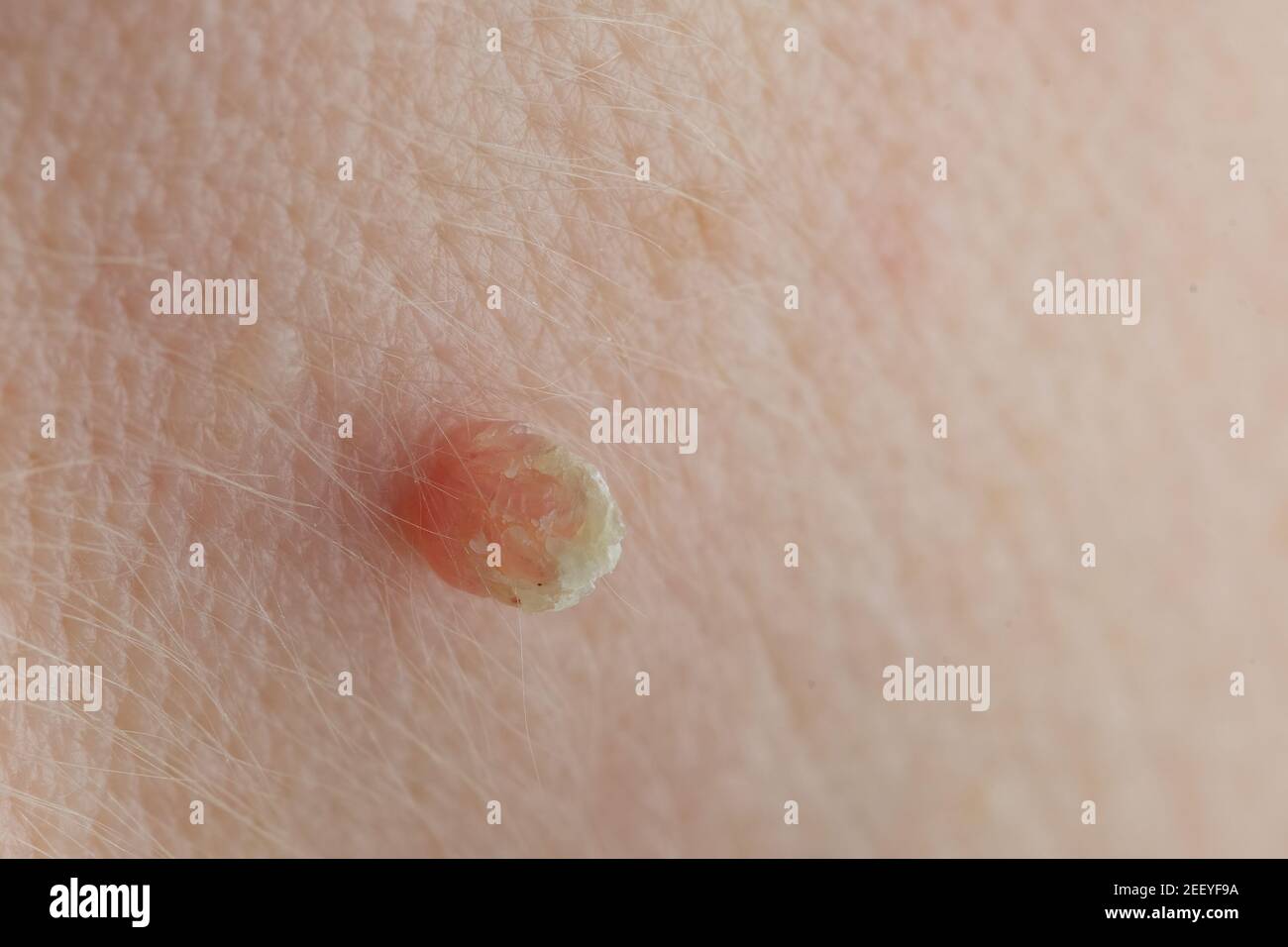 Macro view of a skin tag on the skin of a female face Stock Photo - Alamy