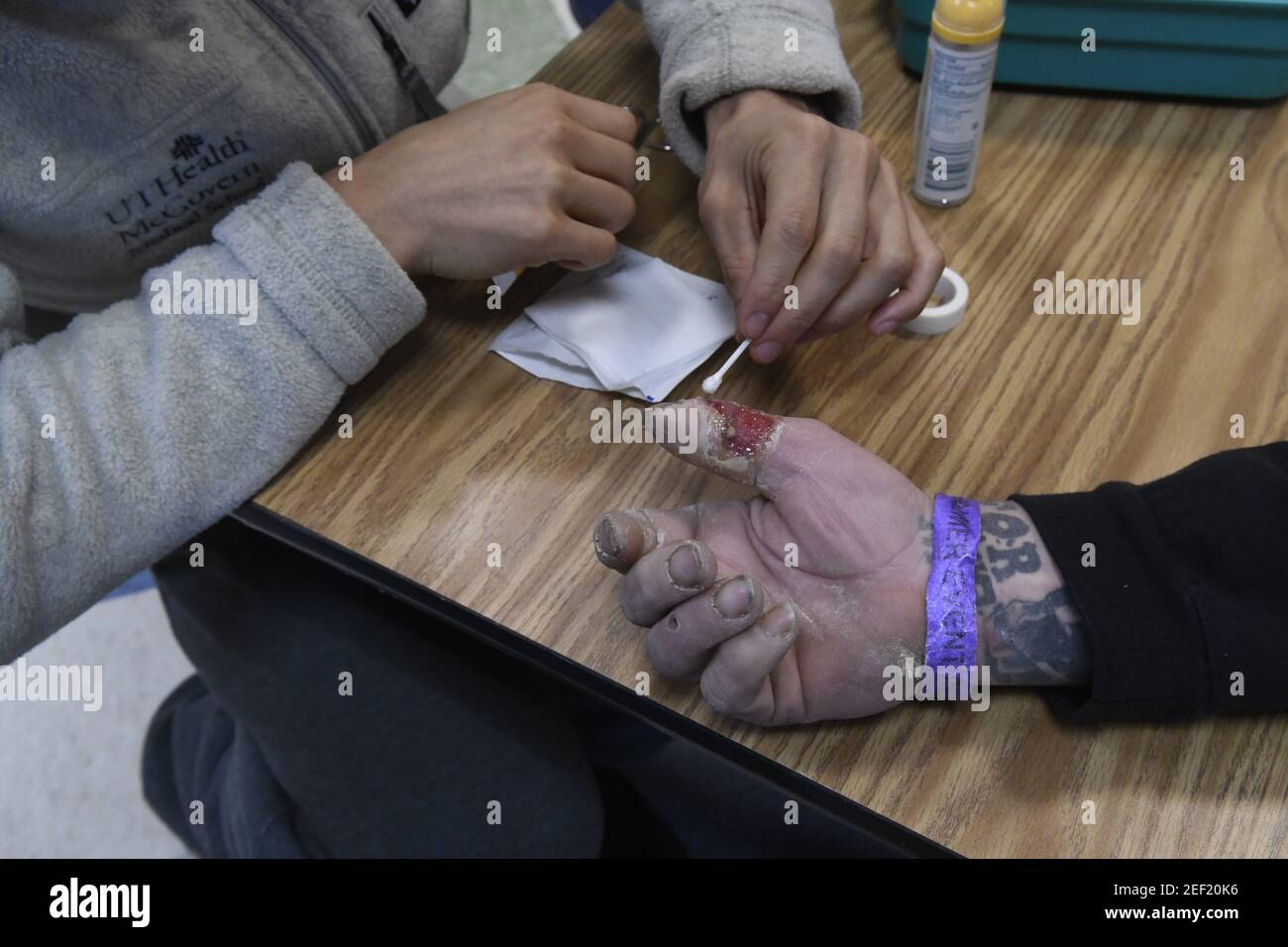 Abscess hand hi-res stock photography and images - Alamy