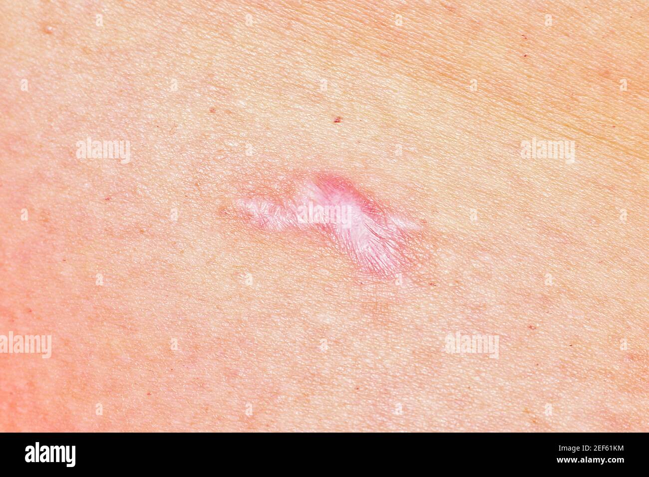 Appendicitis scar hi-res stock photography and images - Alamy