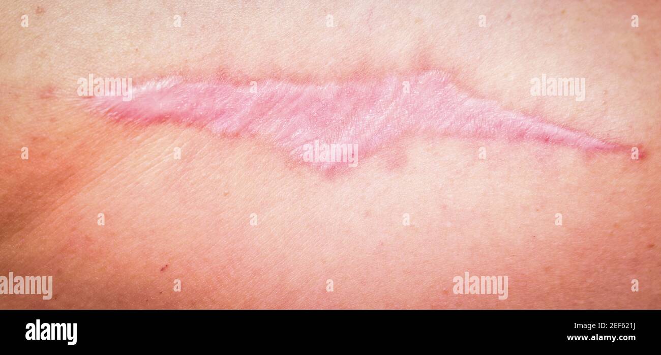 Hypertrophic scars (cicatrix) on the back, muscle tissue transplant ...