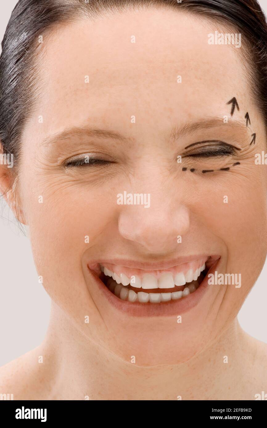 Pre surgical marking hi-res stock photography and images - Alamy