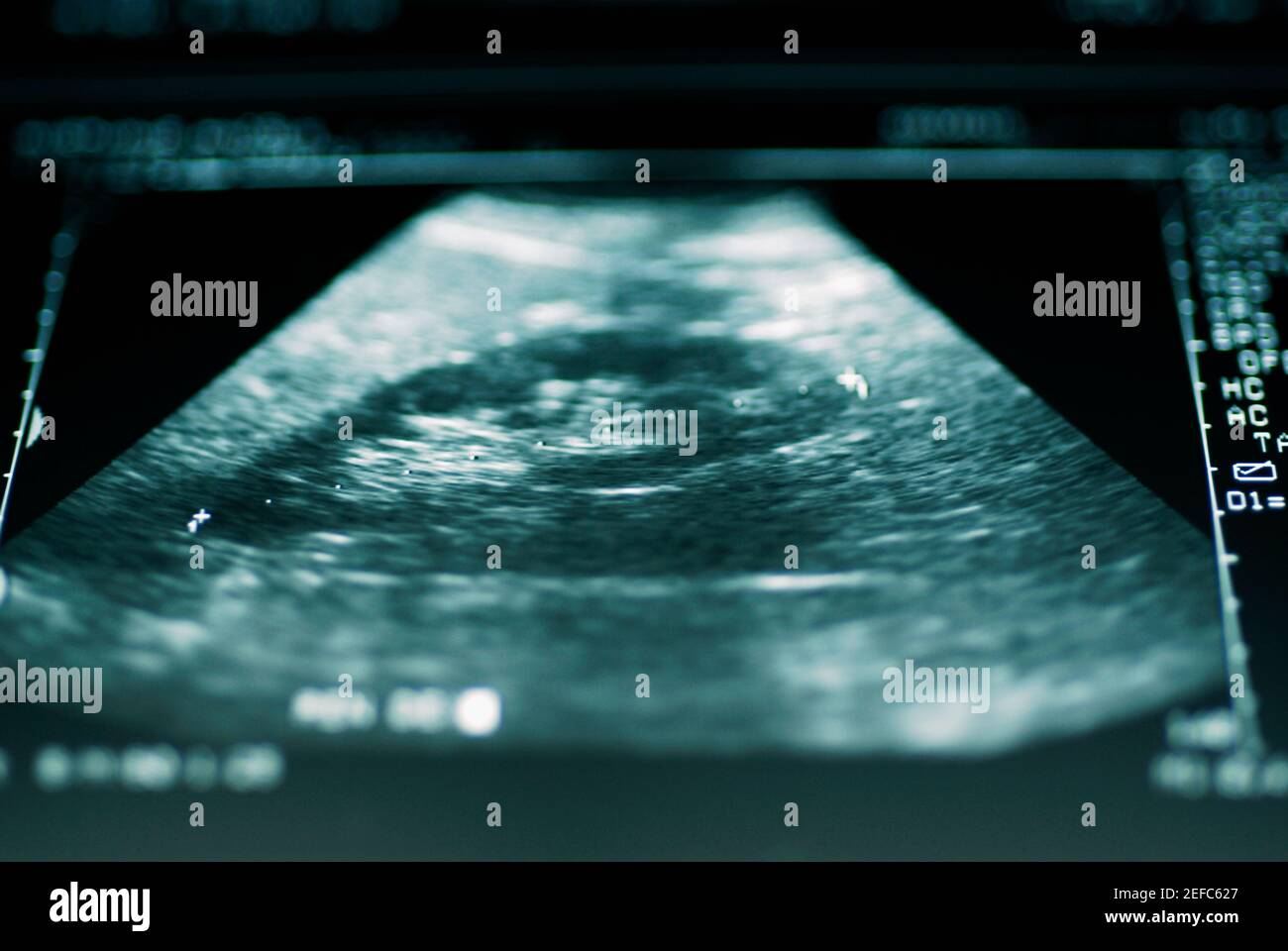 Ultrasound image on monitor close hi-res stock photography and images ...