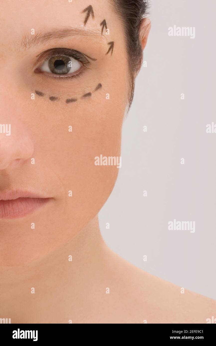 Close up of a young woman with pre surgical markings on her face Stock ...