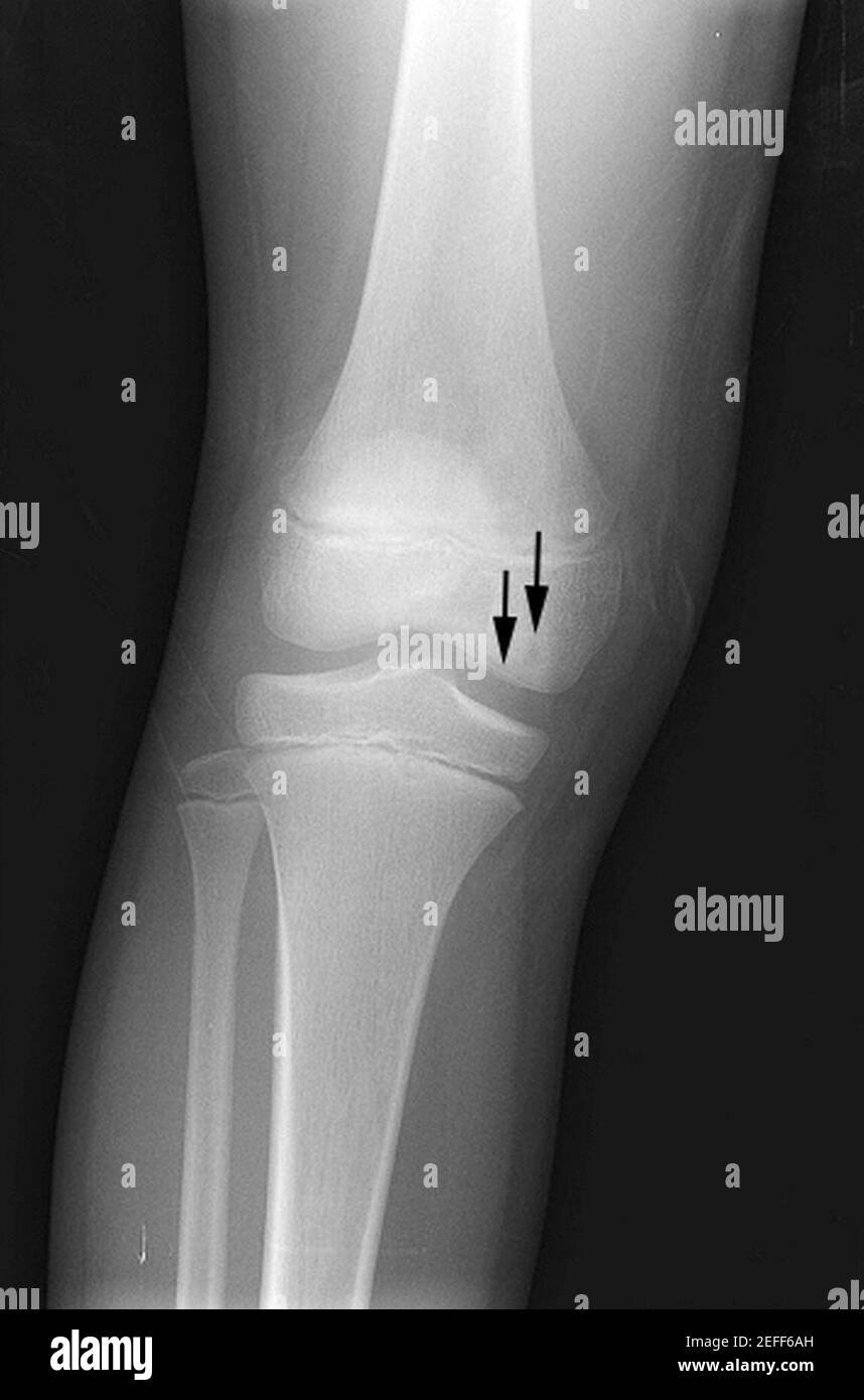 Ocd Black and White Stock Photos & Images - Alamy