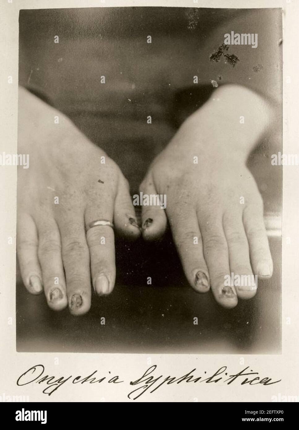 Onychia hi-res stock photography and images - Alamy