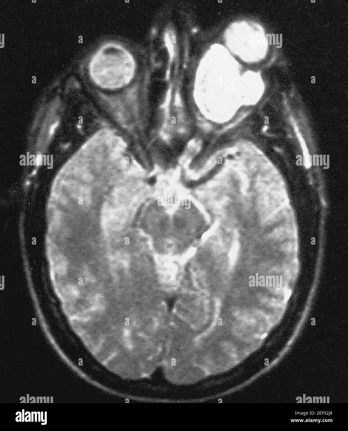 Glioma hi-res stock photography and images - Alamy