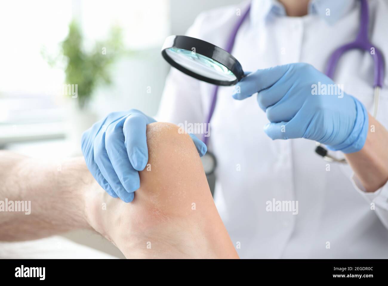 Calluses feet hi-res stock photography and images - Alamy