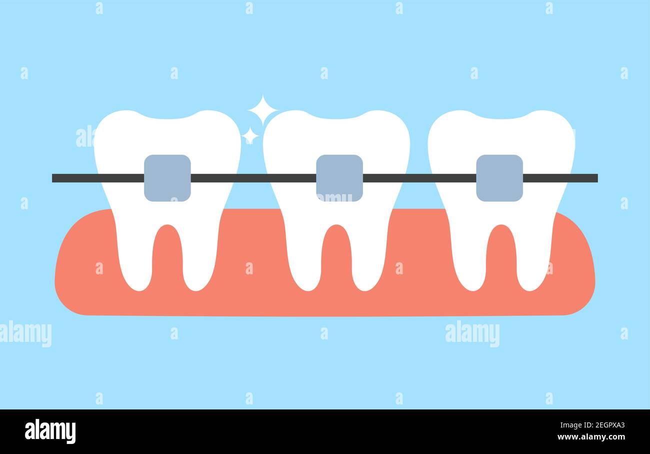 White teeth with dental braces vector flat illustration. Alignment of ...