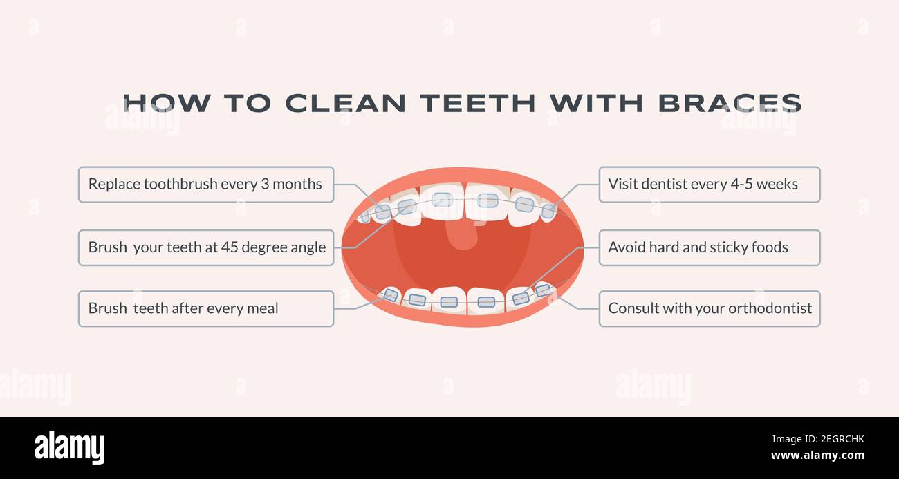 How to clean teeth with braces vector flat information banner template ...