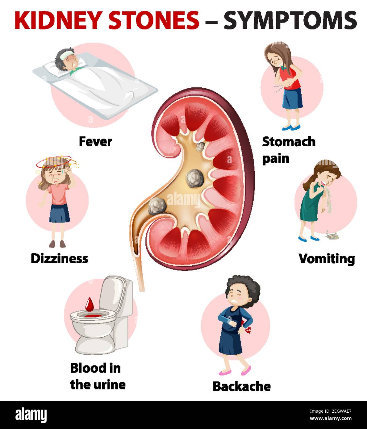 Kidney stones symptoms cartoon style infographic illustration Stock ...