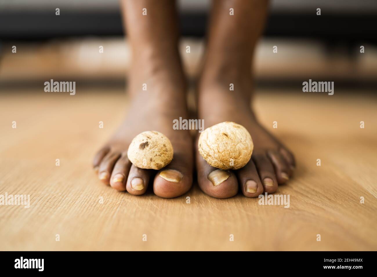 Fungus Mushroom Between Toenail. Smelly Feet And Fungi Stock Photo - Alamy