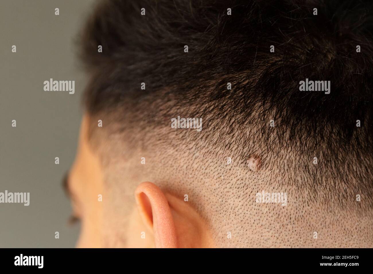 The man has a large mole on his head. Medical examination of the danger ...