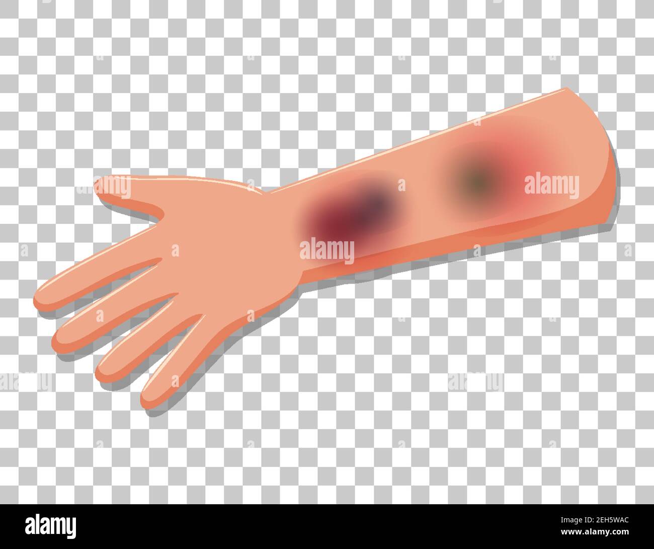 Bruised skin on an arm isolated on transparent background illustration ...