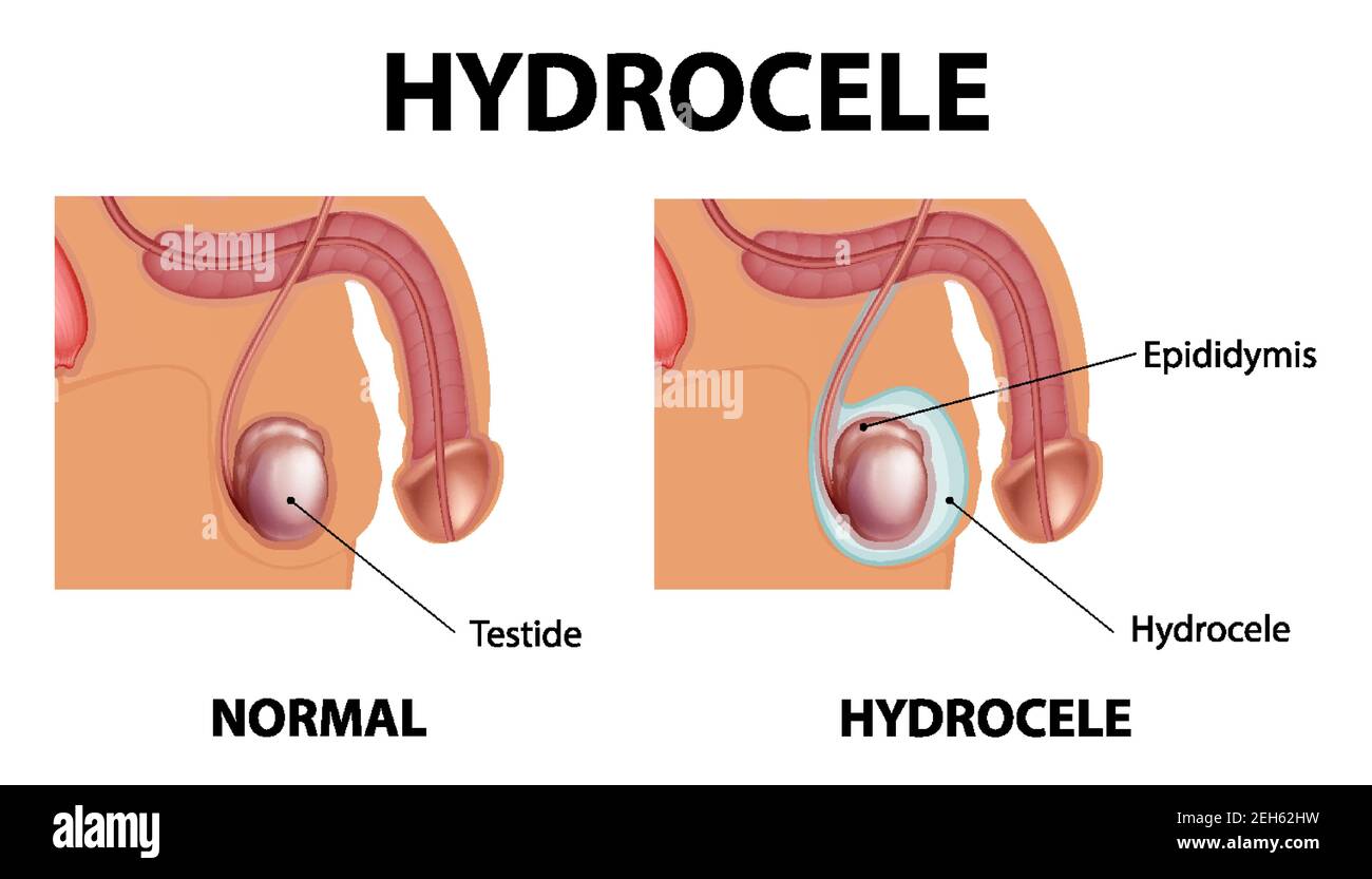 Human Hydrocele Symptoms Diagram Illustration Stock Vector Image And Art