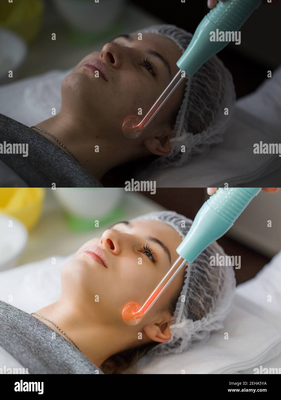 Violet ray treatment on face at the beautician. Before and After. A ...