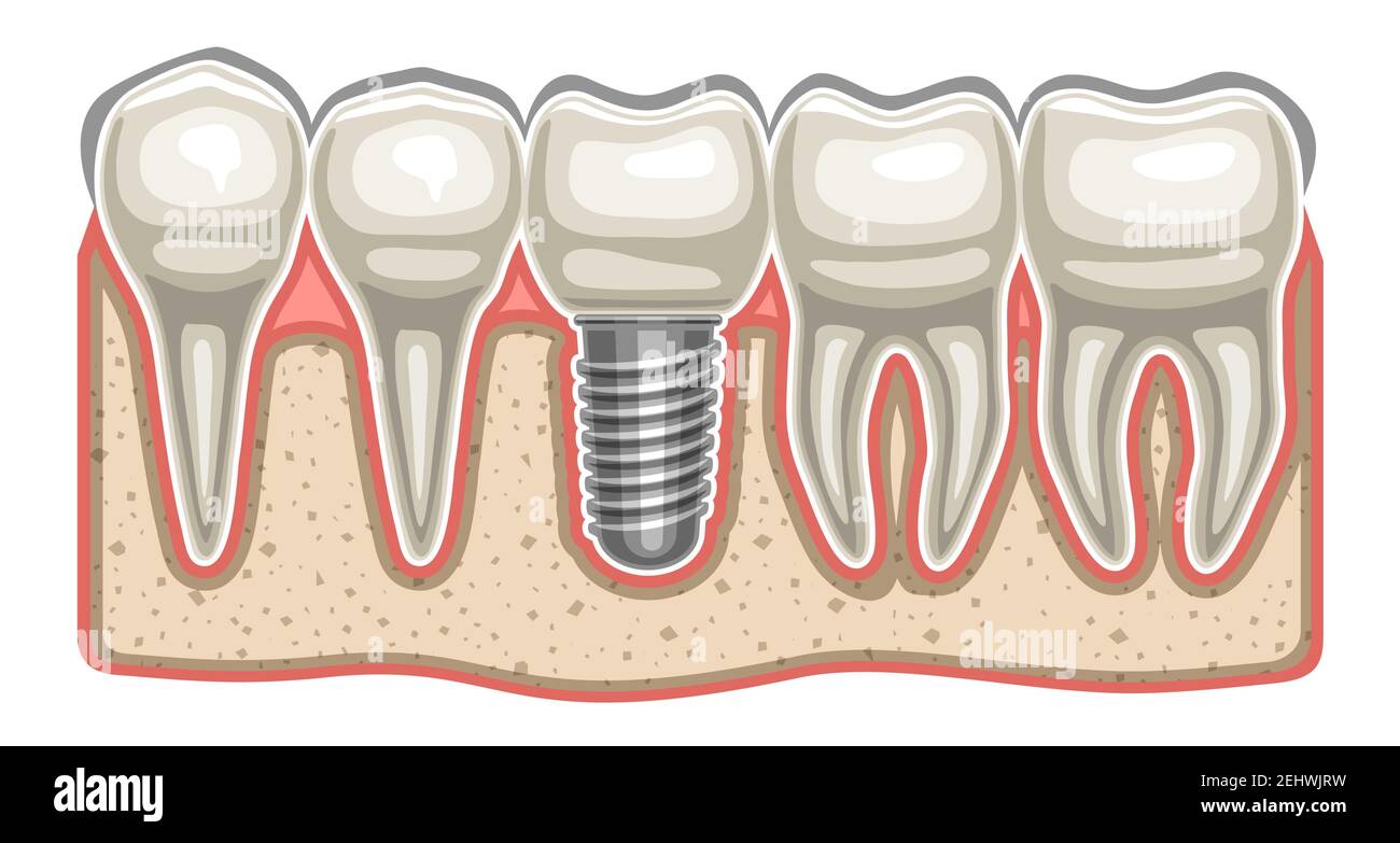 Vector illustration of Dental Implant, 5 human teeth in a row and ...