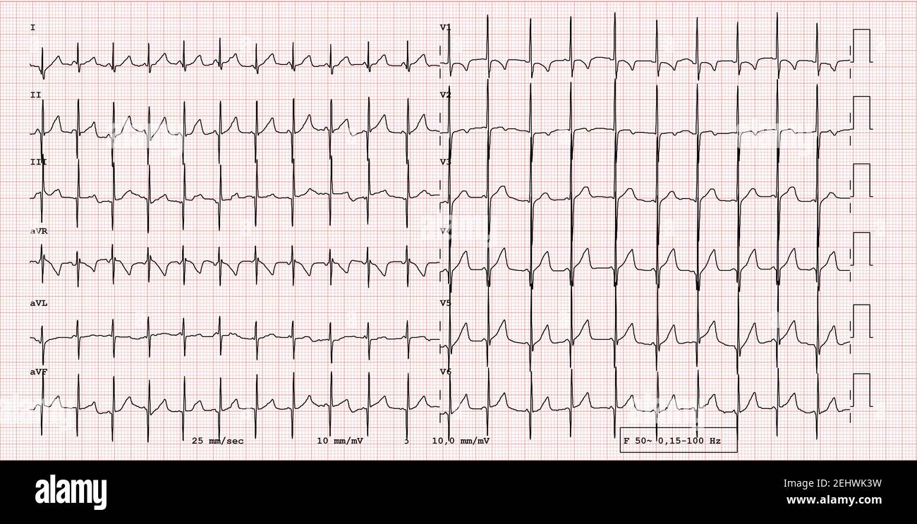 Normal 12 Lead Ecg