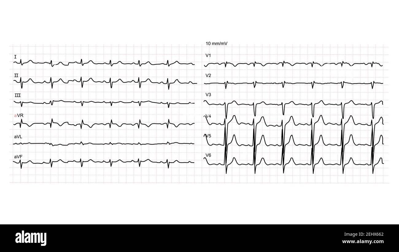 Illustration of normal human electrocardiogram or EKG on white ...