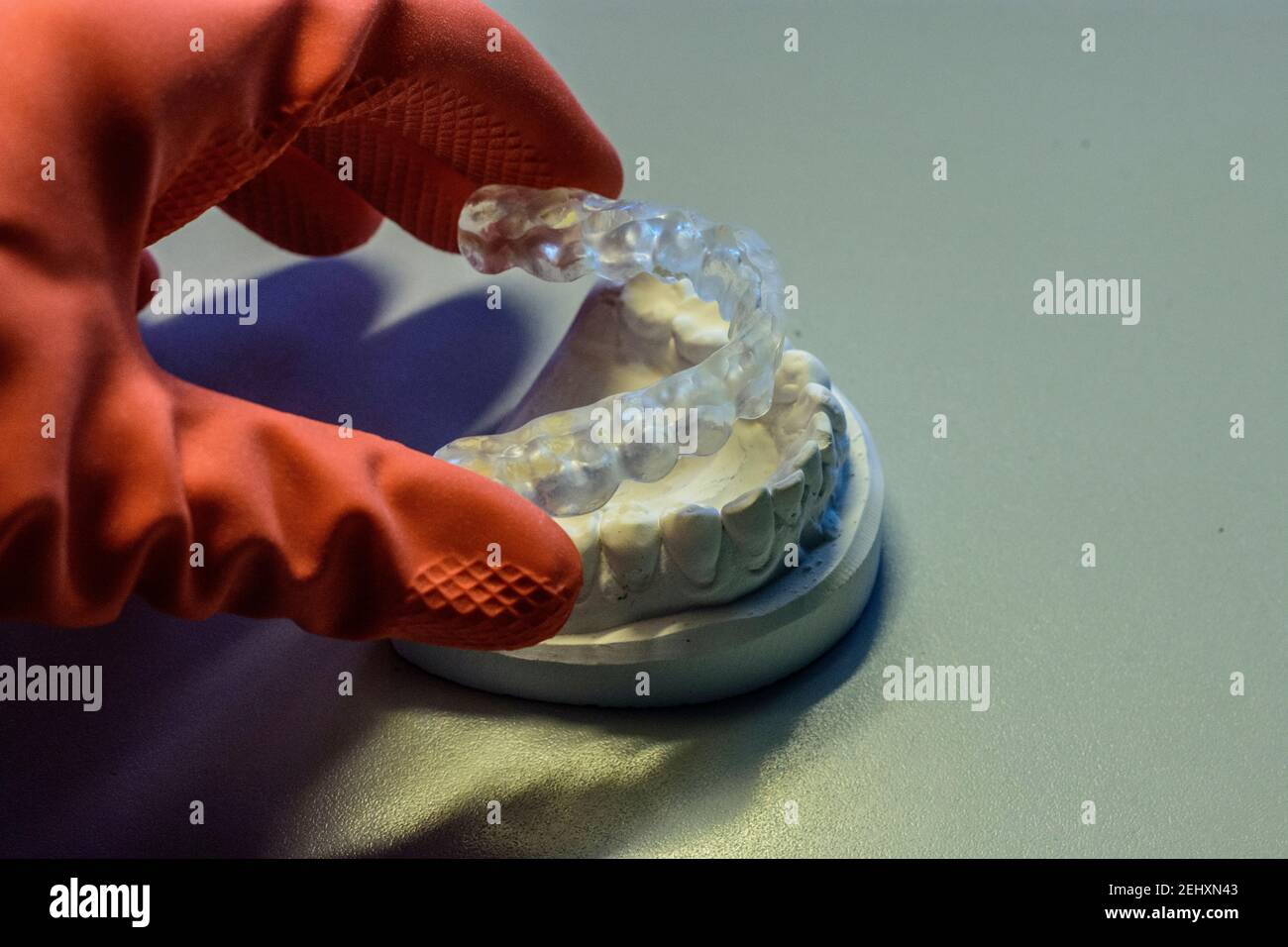 grinding splint, occlusal splint (Knirscherschiene, Aufbissschiene ...