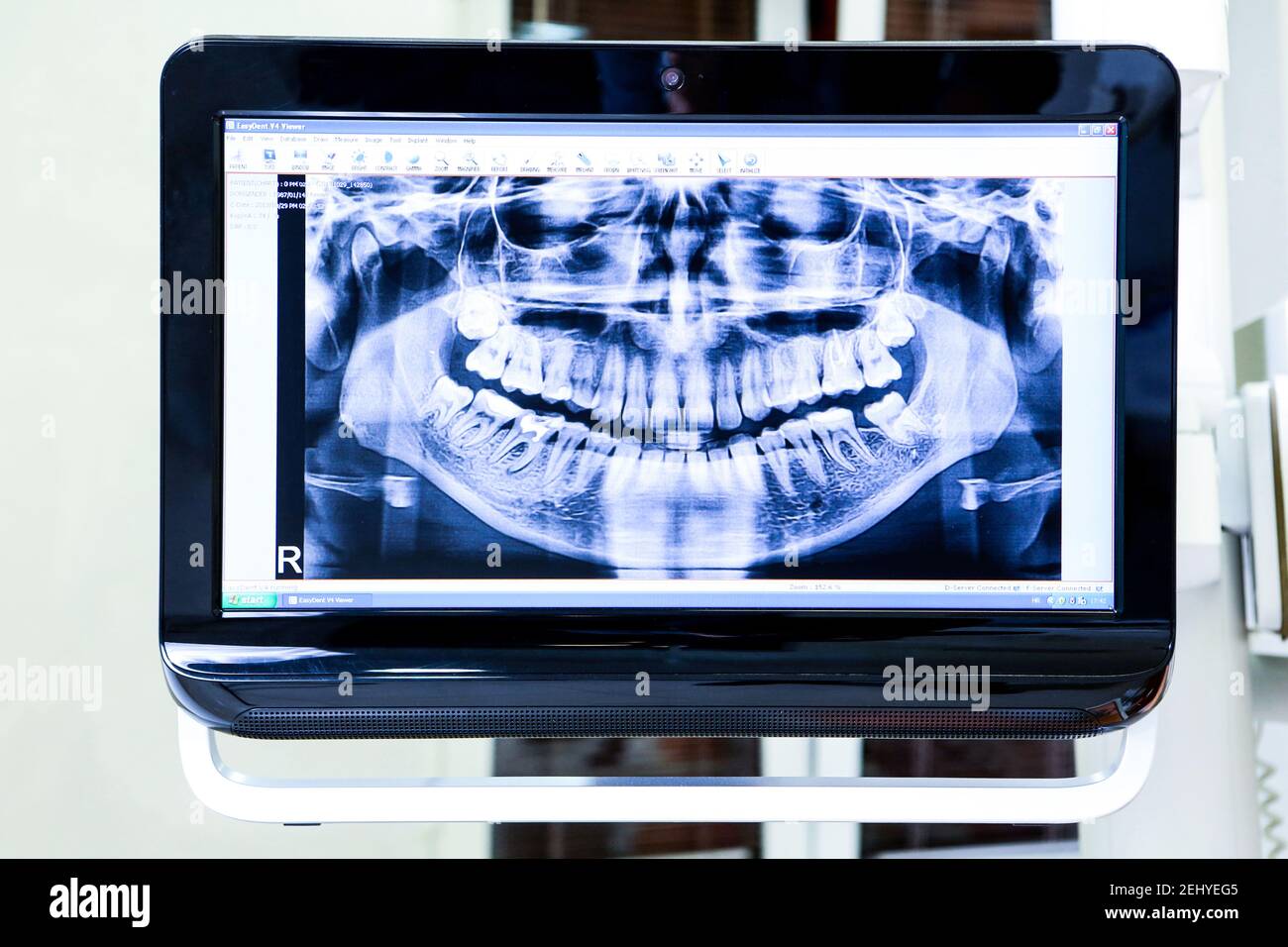 A Monitor Showing the X Ray of a Mouth Stock Photo - Alamy