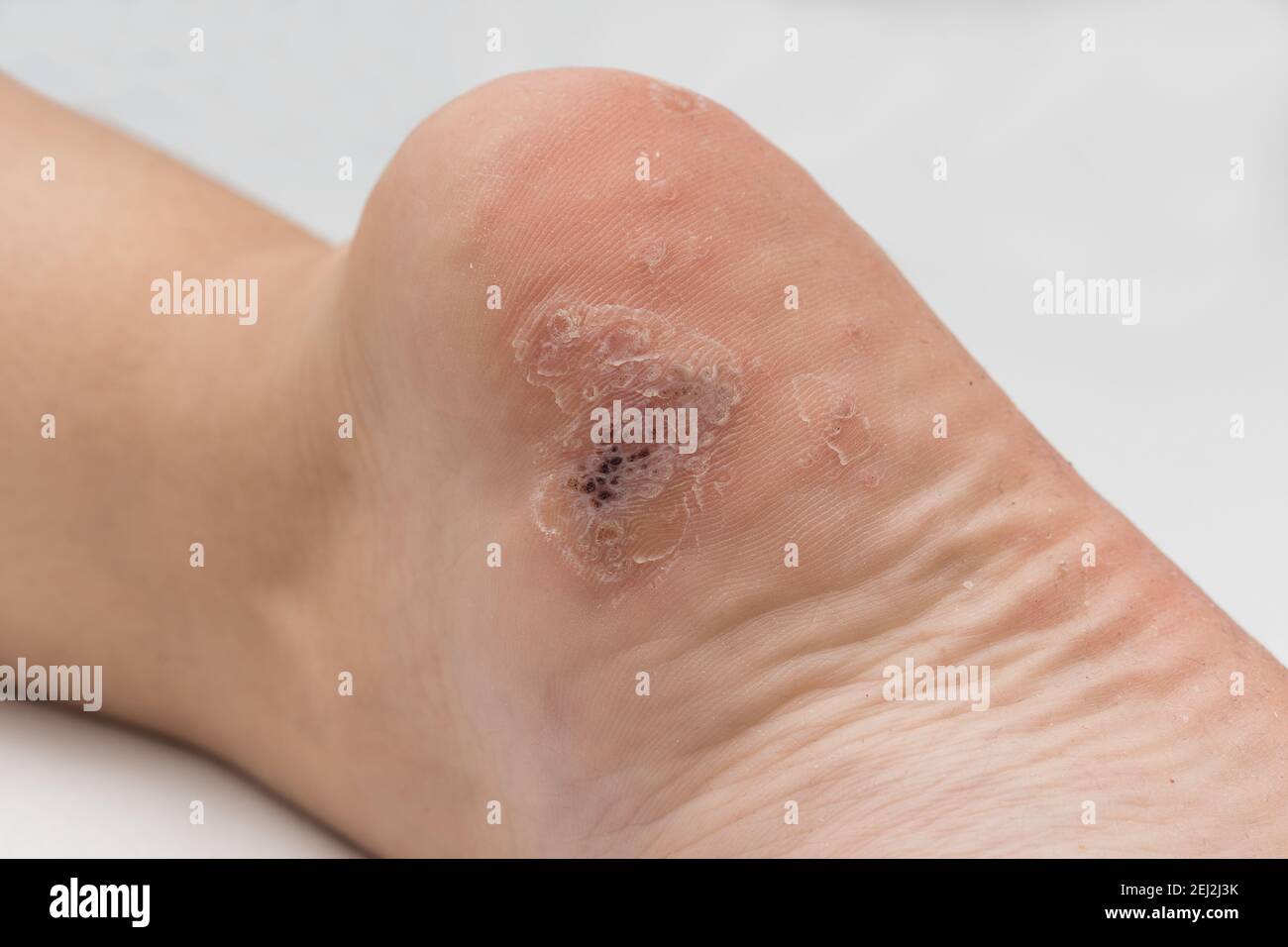 Plantar wart close up on the bottom of foot heel caused by the human ...