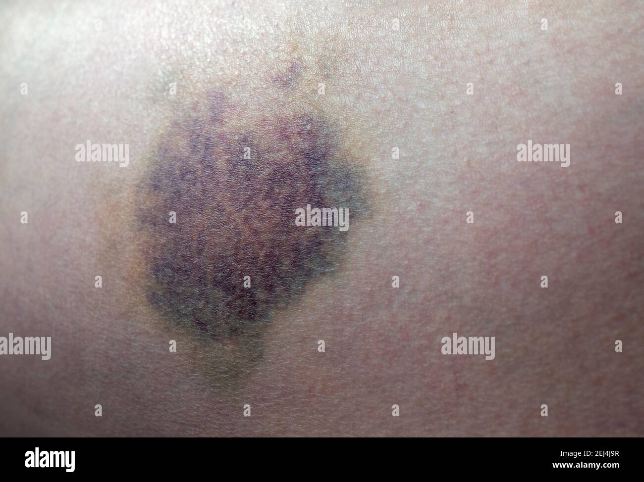 Big purple bruise on a leg Stock Photo - Alamy