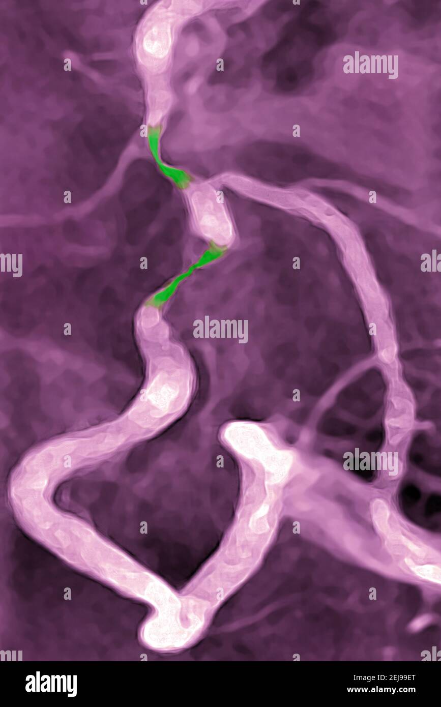 Coronary arteriography hi-res stock photography and images - Alamy