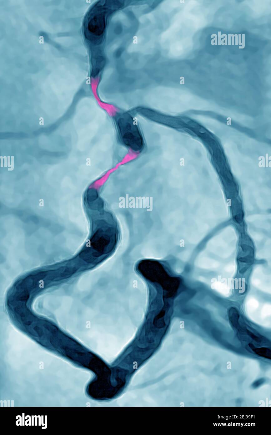 Coronary arteriography hi-res stock photography and images - Alamy