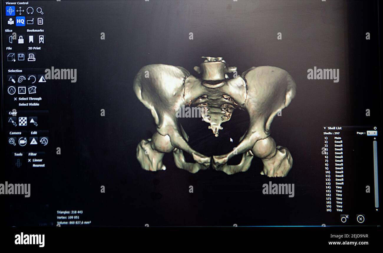 3d ct reconstruction hi-res stock photography and images - Alamy
