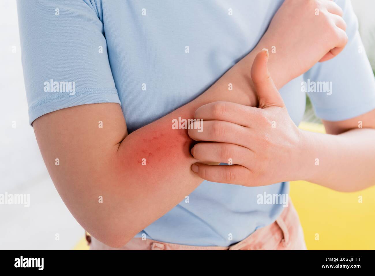 Scratching arm hi-res stock photography and images - Alamy