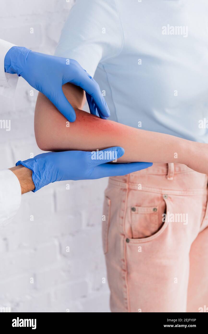 Latex allergy hi-res stock photography and images - Alamy