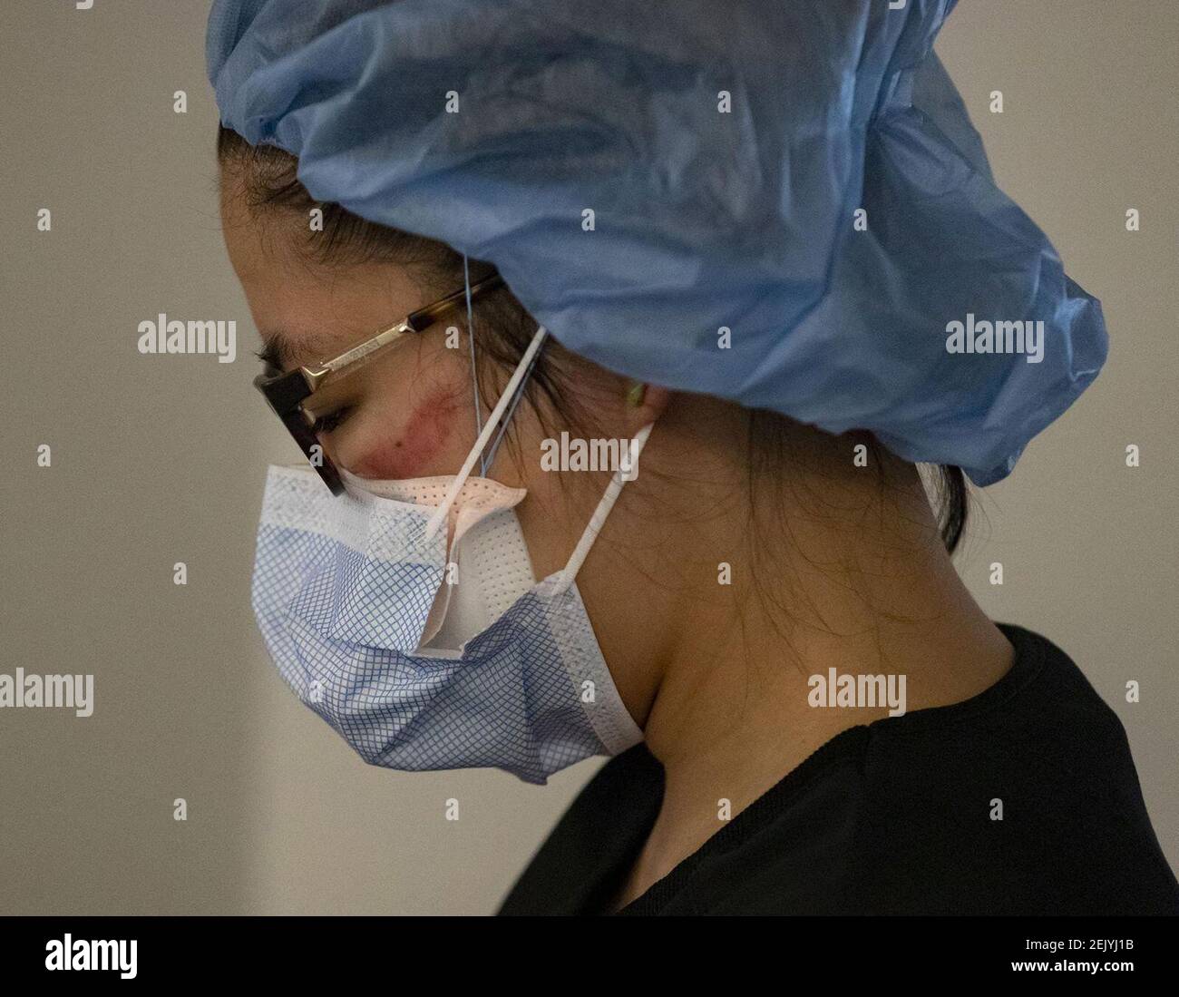 Nurse Amanda Chow has goggle marks on her face after leaving the room ...