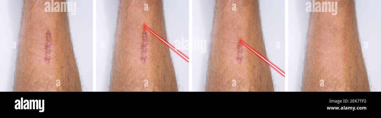 Laser surgery beam hi-res stock photography and images - Alamy