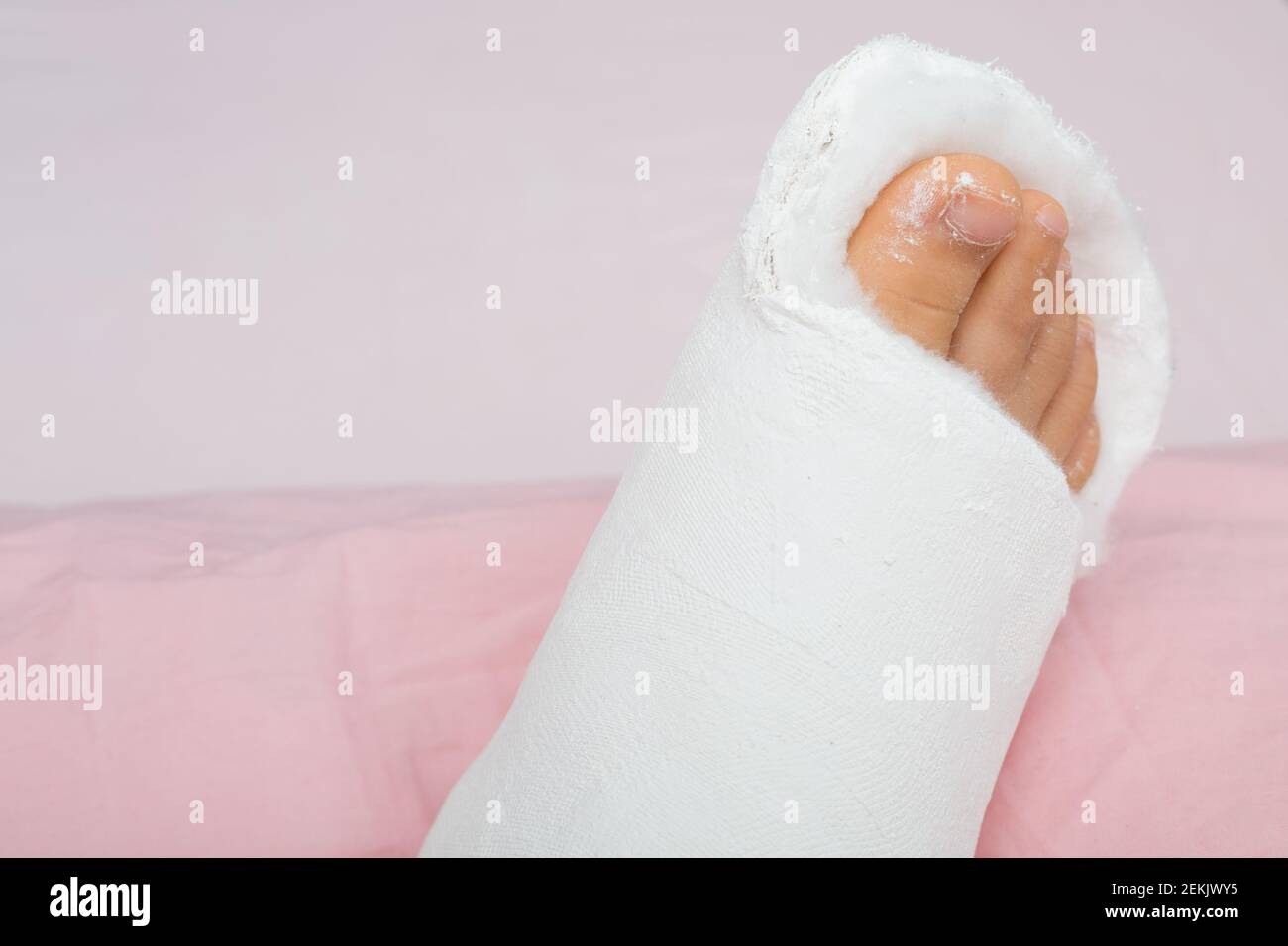 Close up bone fractures on the leg of a child. Children's leg in a cast ...