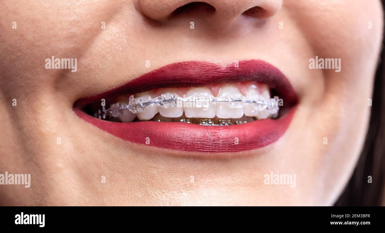 Beautiful smile and close up of braces, happy smile concept Stock Photo ...