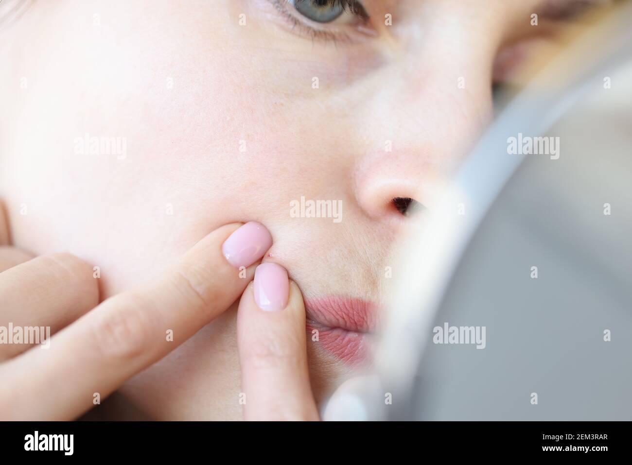 Woman presses pimple on her face closeup Stock Photo - Alamy