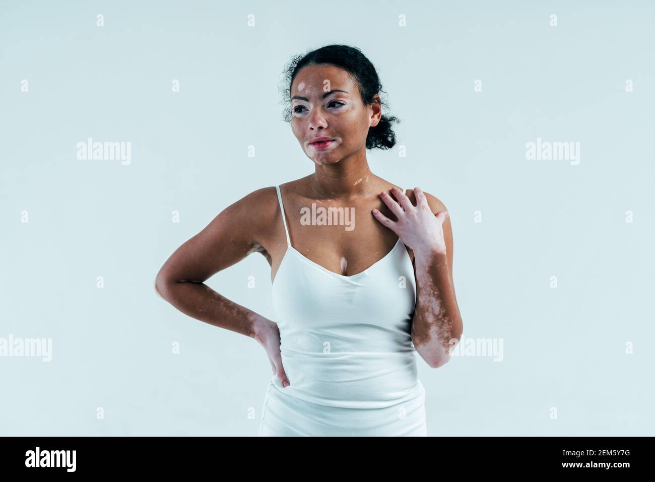 Beautiful woman with vitiligo skin posing in studio. Concept about body ...