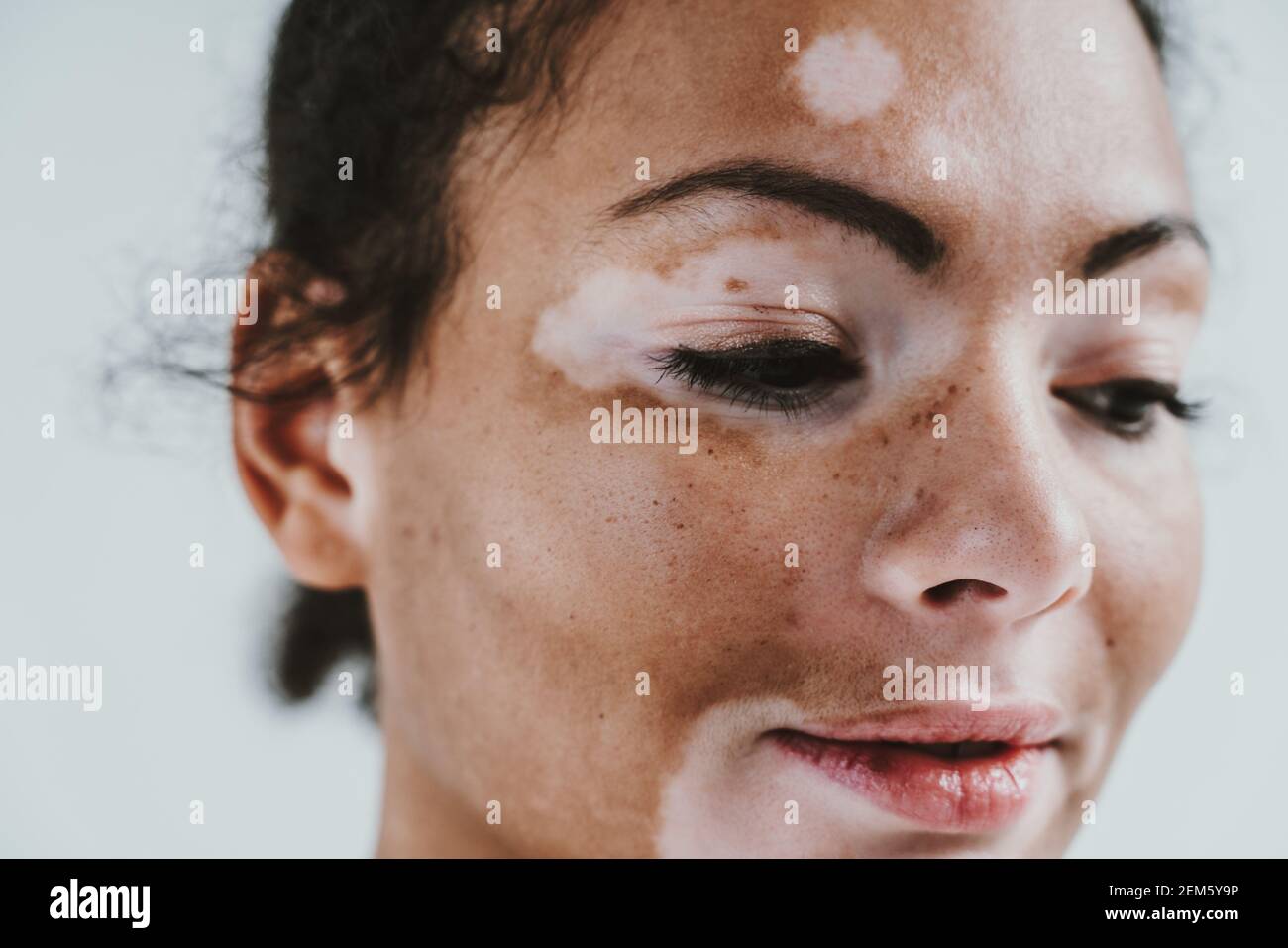 Beautiful woman with vitiligo skin posing in studio. Concept about body ...