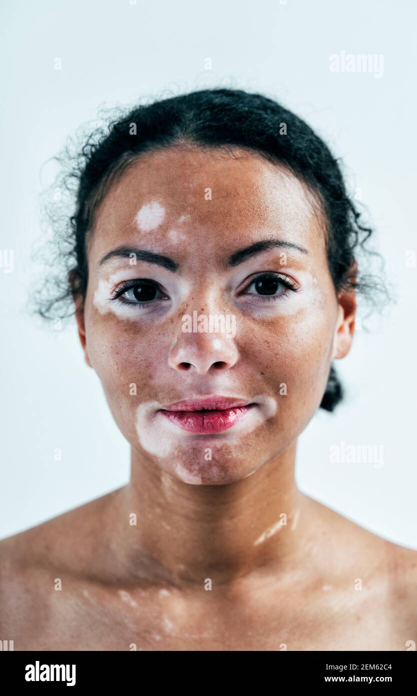Vitiligo Full Body