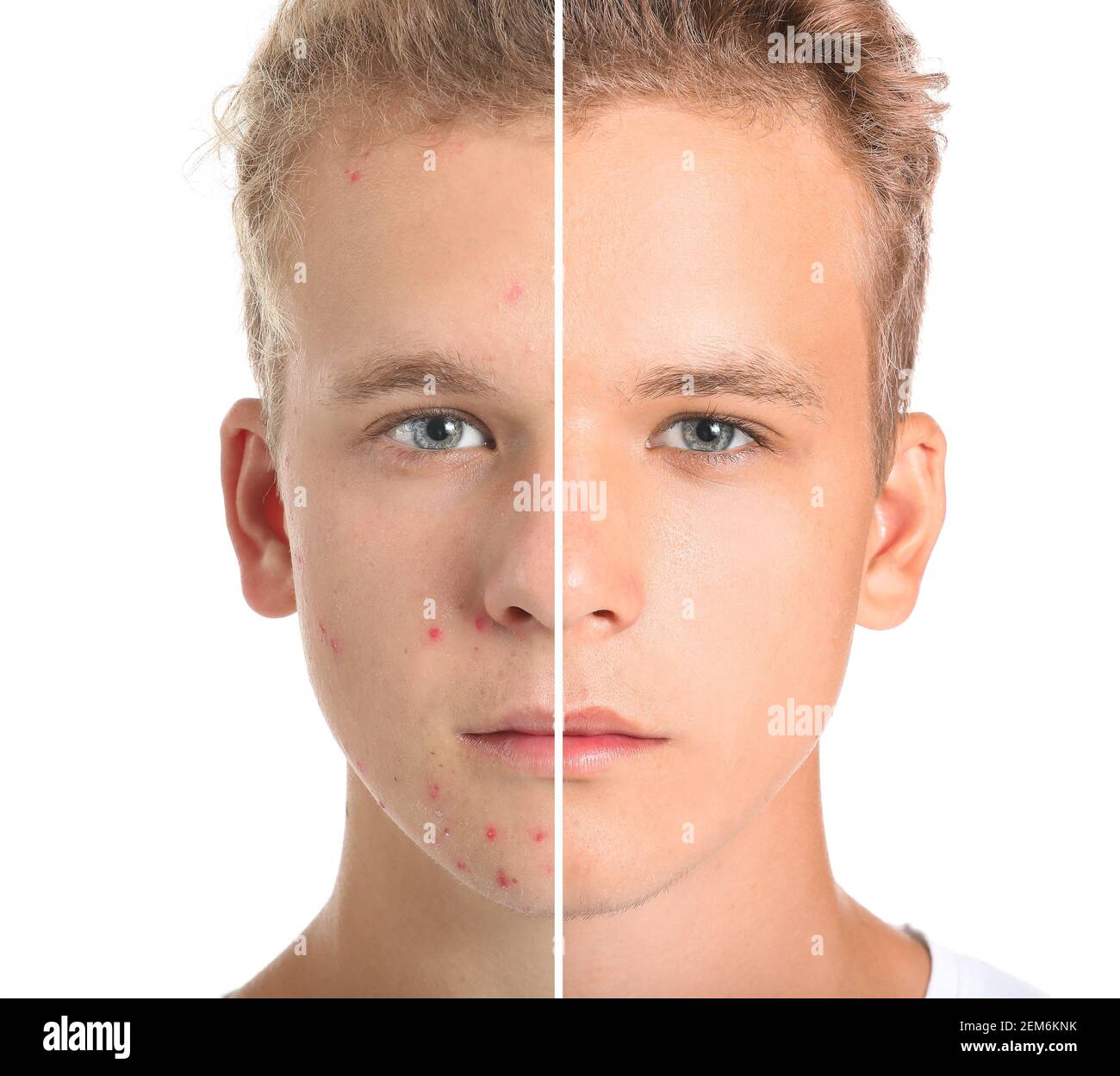 Acne Vulgaris Before And After