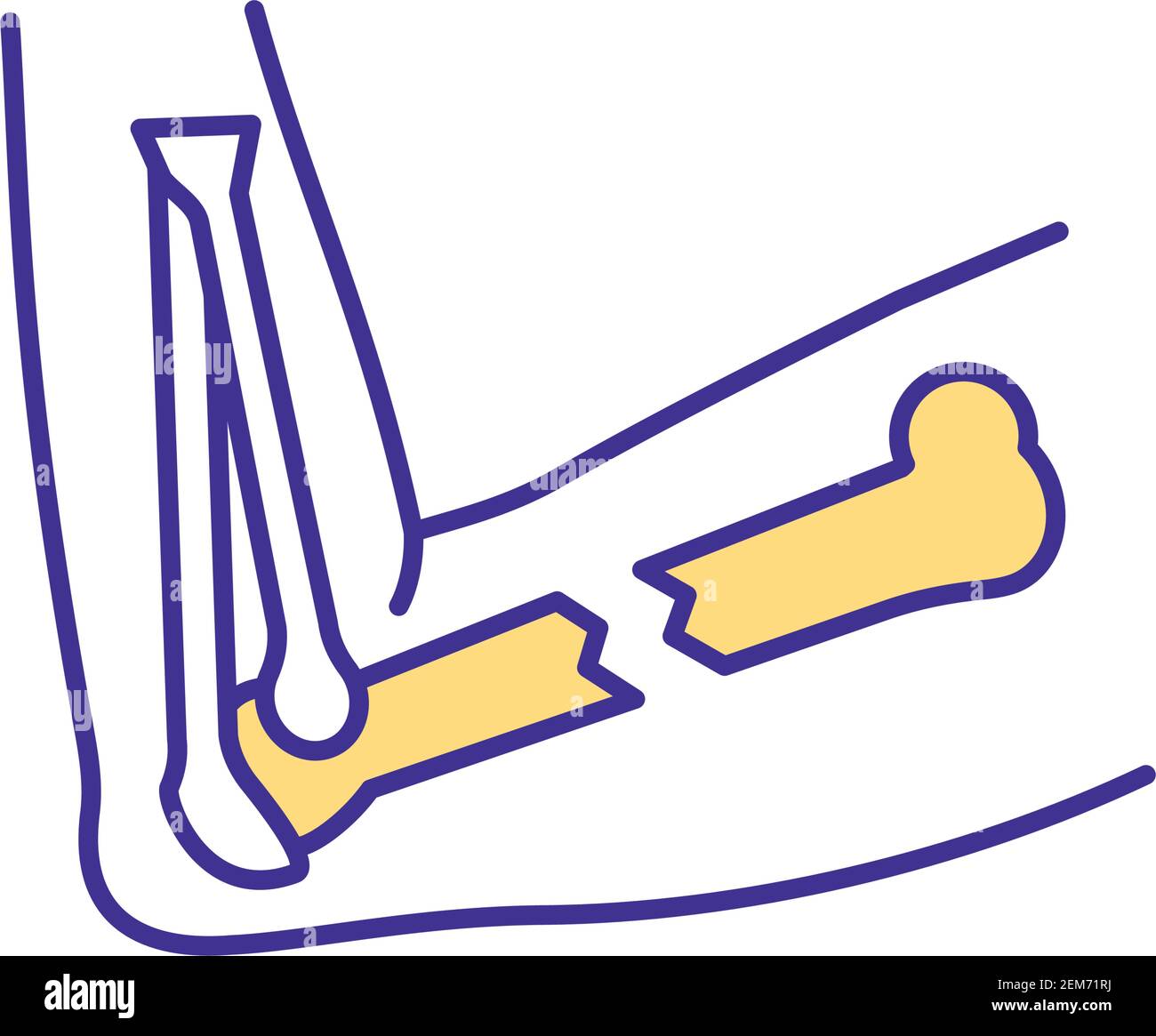 Simple fracture hi-res stock photography and images - Alamy