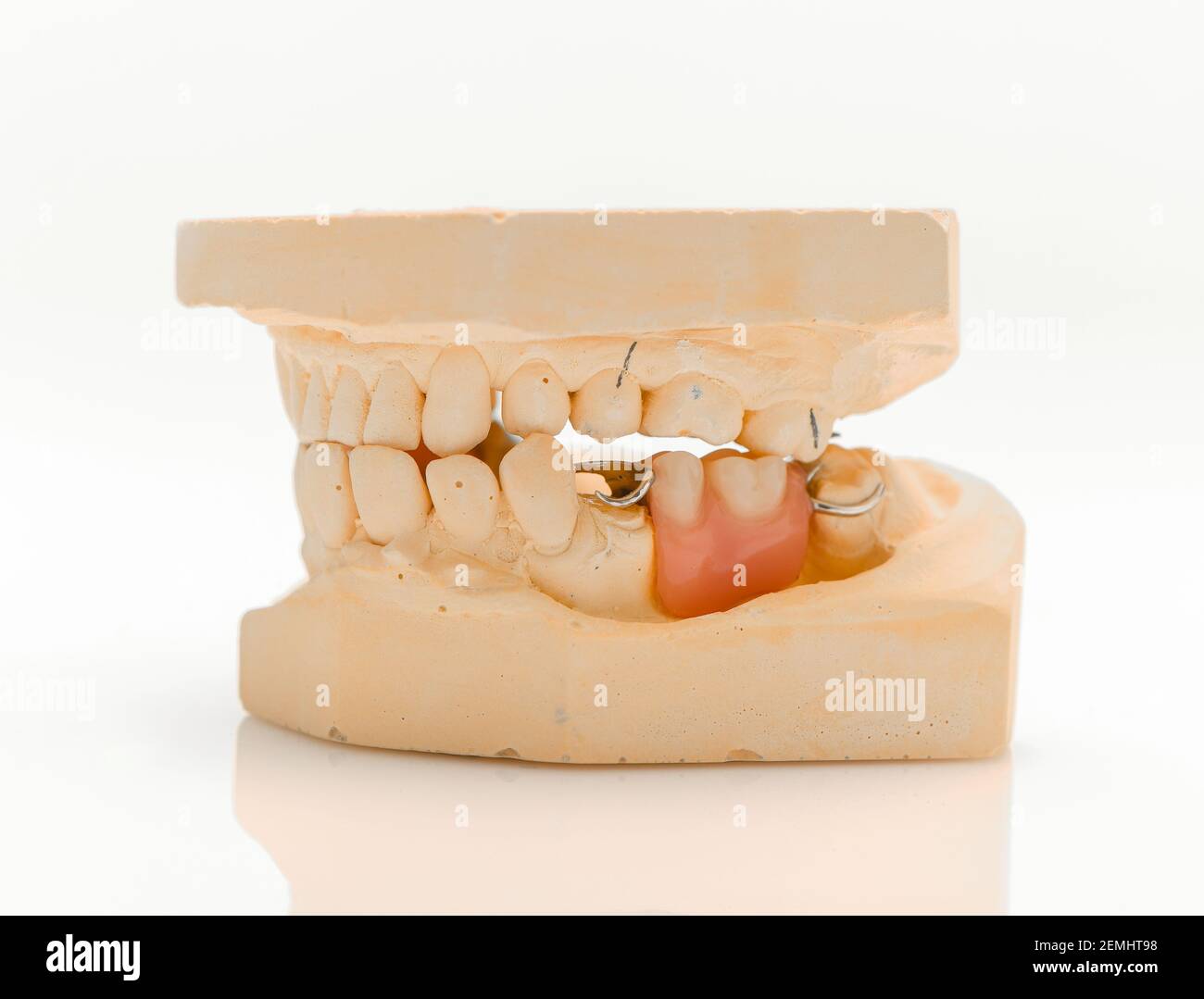 Set of pictures with a Partial denture cast and denture showing missing ...